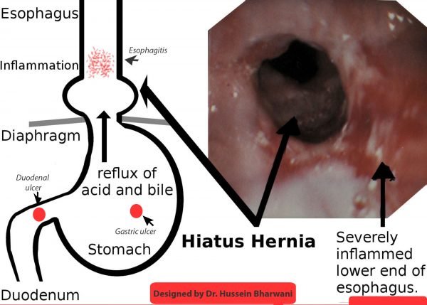 Balancing risks and benefits of using heartburn and peptic ulcer ...